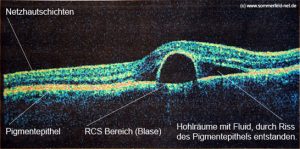 RCS-Diagnosen und Tests – The Blind Spot – Fotografie, RCS, Vobiko und ...
